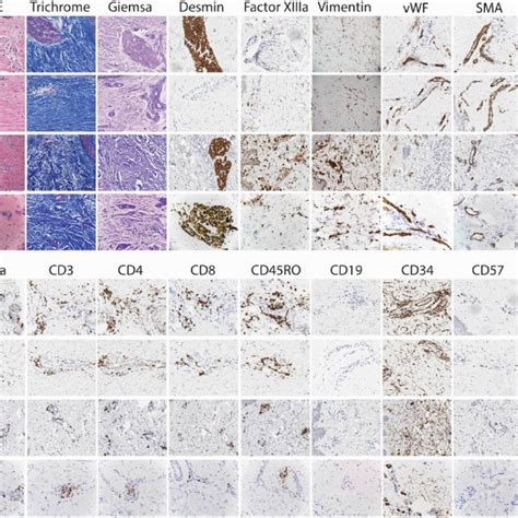 Detailed Histological Analysis Of Pyoderma Gangrenosum Pg Scars N Download Scientific