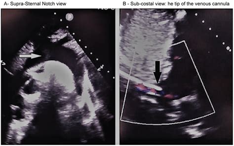 Suprasternal Notch Echo