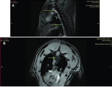 The Investigated Aorta Segment Sagittal Section A And An Example Of Download Scientific