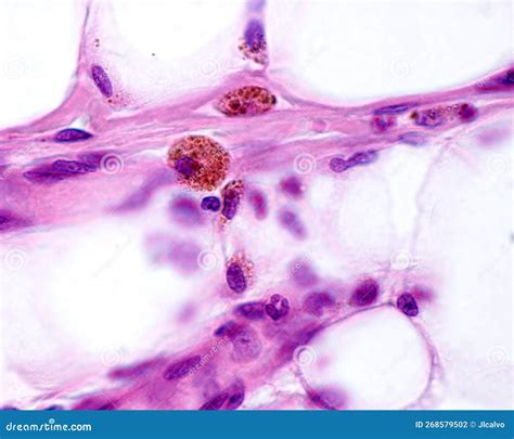 Peritoneal Macrophage Containing Hemosiderin
