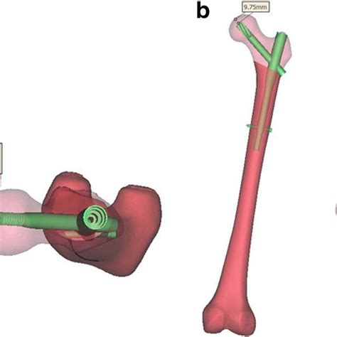 Abbreviations Fea Finite Element Analysis Znn Zimmer Natural Nail Download Scientific