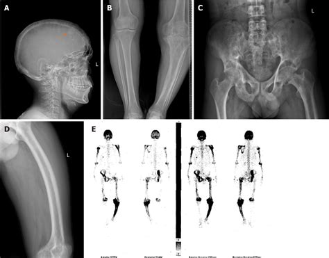 Pictures Of Bone Diseases