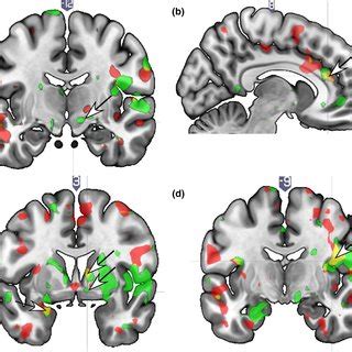 Brain Localizations Showing Significant Brain Response Interactions Download Scientific Diagram