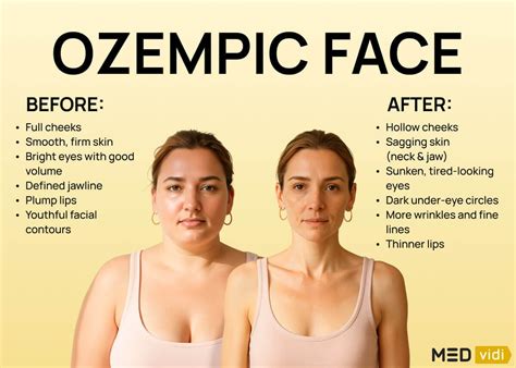 Ozempic Face” And Facial Ageing After Rapid Weight Loss What It Is And