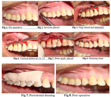 What Is Regenerative Periodontal Surgery At April Hyde Blog