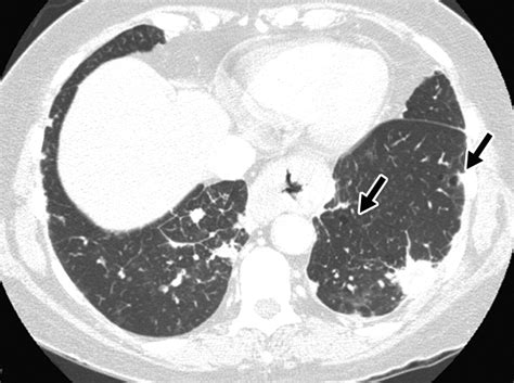 Diffuse Cystic Lung Disease At High Resolution Ct Ajr