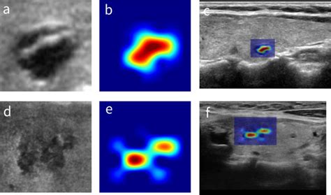 The Cams Of Thyroid Nodules A A Benign Thyroid Nodule B The