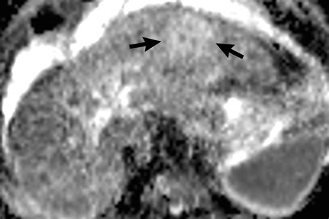 Expected And Unexpected Imaging Findings After 90y Transarterial Radioembolization For Liver