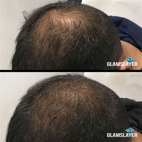 Boost Hair Regrowth With Microneedling And Serum Before And After