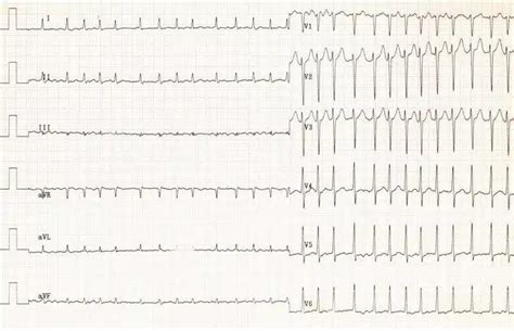 نمونه های تفسیر نوارقلب Ecg یا Ekg شرکت نبض