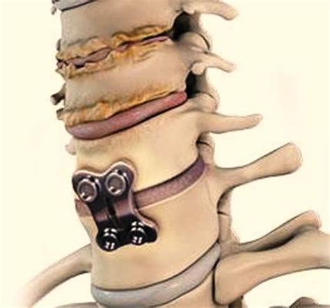 Understanding Adjacent Segment Disease Asd After Spinal Fusion Surgery