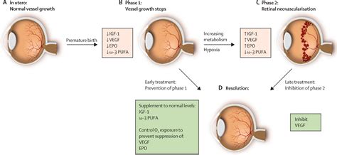 Retinopathy Of Prematurity The Lancet
