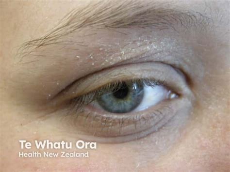Eyelid Dermatitis Treatment Symptoms And Causes