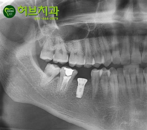 치아를 빼낸 후 즉시 임플란트 수술한 케이스