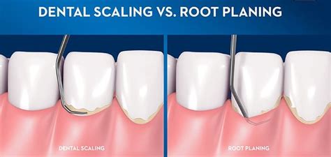 Scaling And Root Planing Perio Pdx