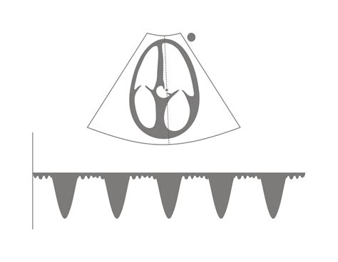Infographic Of Echocardiography Of Left Ventricular Outflow Tract