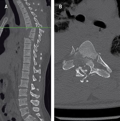 Fractura Compuesta De La Columna Vertebral Fractura Vertebral