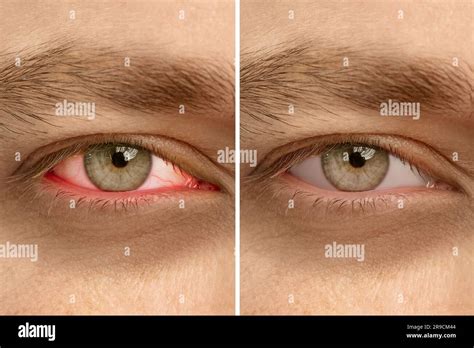 Collage With Photos Of Man Before And After Conjunctivitis Treatment