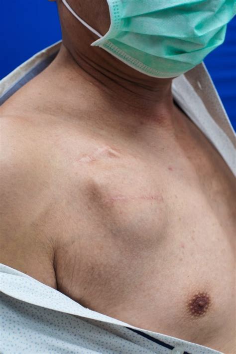 Implanting A Pacemaker My Rhythm Device