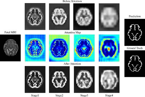 A Deep Attentive Convolutional Neural Network For Automatic Cortical Plate Segmentation In Fetal Mri