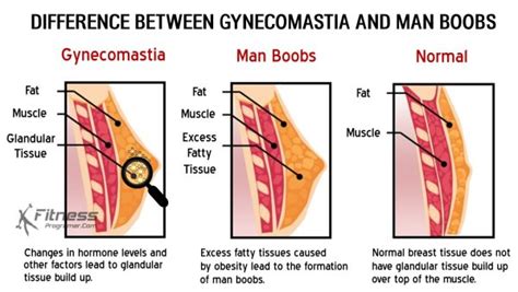 Learn How To Get Rid Of Man Boobs And Gynecomastia