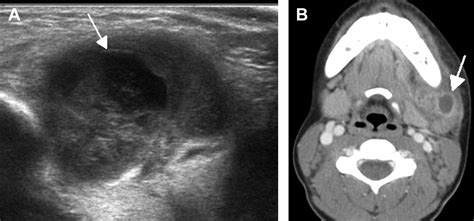 Ultrasonography Of Cervical Lymph Nodes Radiologic Clinics