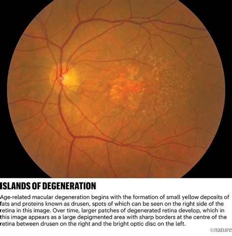 Geographic Atrophy The Roadmap To Geographic Atrophy Treatment A