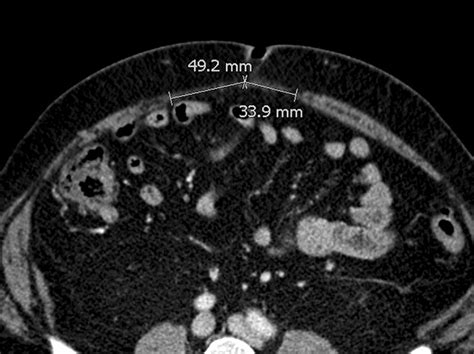 Representative Image Of Diastasis Recti And Measurement Technique