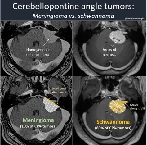 Stereotactic Radiosurgery Posted On Linkedin