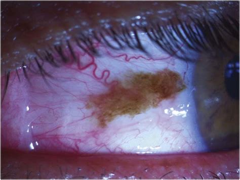 Left Eye Conjunctival Melanosis Download Scientific Diagram
