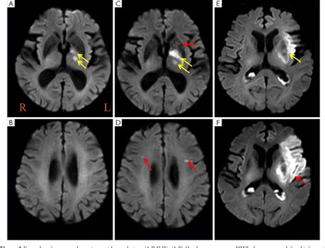 Figure 2 From Predictive Value Of Perfusion Weighted Imaging For Early New Lesions After Stroke
