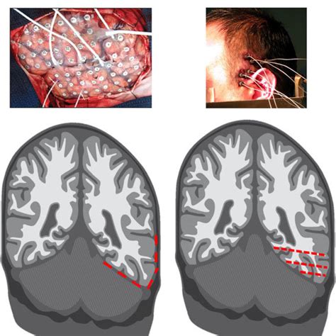 First Seizure Solid Vertical Lines Mark Seizure Onset And Download Scientific Diagram