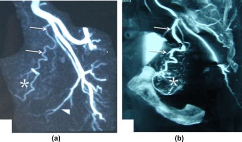 Contrast Enhanced Magnetic Resonance Angiography In The Identification Of Prostatic Arterial
