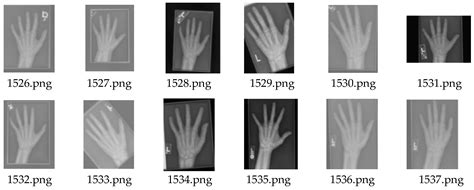 Symmetry Free Full Text Symmetry Based Fusion Algorithm For Bone