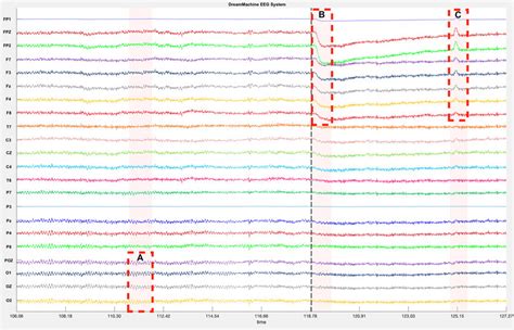 Showcases Raw Eeg Time Series Recordings In Two Distinct Conditions Download Scientific Diagram