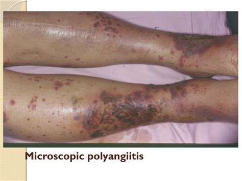 Vasculitis Pptx Different Types Of Vasculitis Ppt