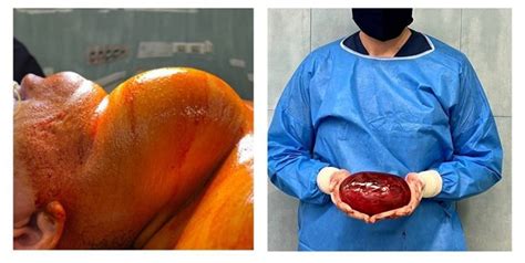 جرایی غده تیرویید 2 کیلویی بیمار کرجی به گزارش خبرگزاری فارس