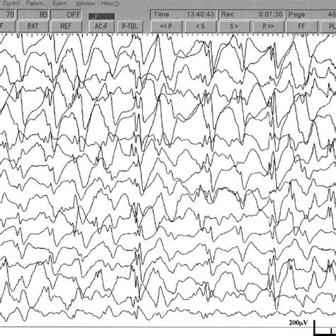 Pdf Angelman Syndrome Is There A Characteristic Eeg