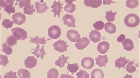 Acanthocytes Vs Echinocytes Youtube