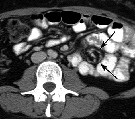 Post Gastric Bypass Internal Hernia Radiology At Carrie Hernandez Blog