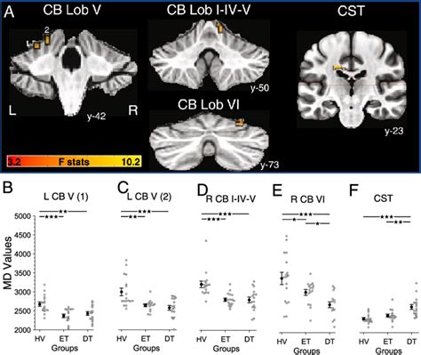 Mean Diffusivity Md A Brain Areas With Significant Groups