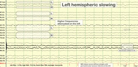 Focal Or Lateralized Slowing