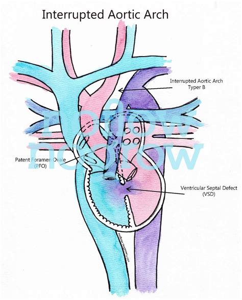 Interrupted Aortic Arch Etsy
