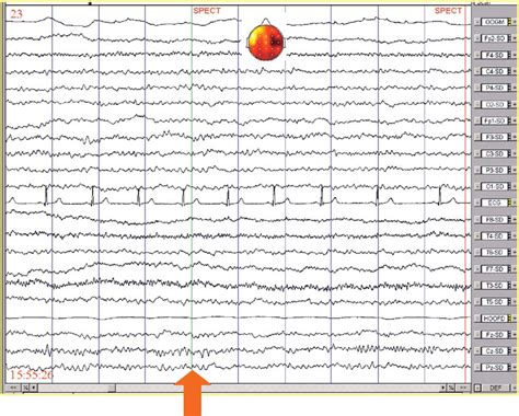 Source Derivation Sensitivity 100 Microvolt During The Eeg We See