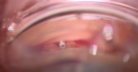 Istent Infinite And Idose Implantation Eyetube