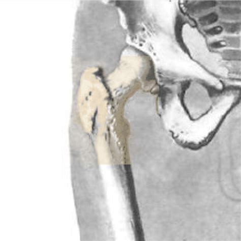 Счупване в областта на бедрената шийка пертрохантерно счупване интертрохантерно счупване