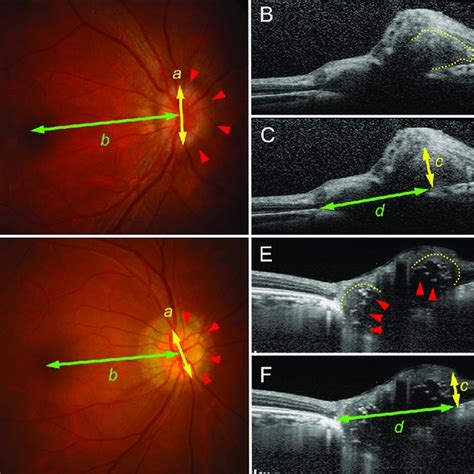 Types Of Visual Field Defects A Normal Visual Field B Enlarged