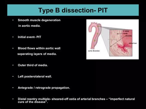 Type B Aortic Dissection Pptx