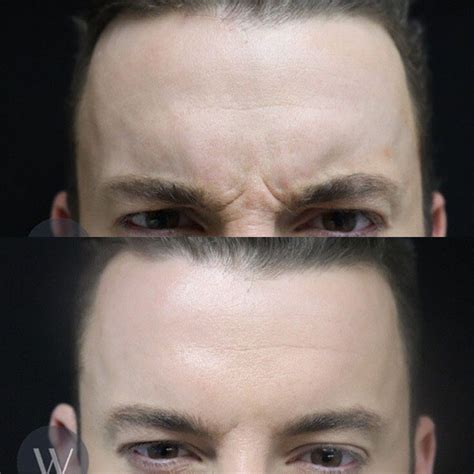 Daxxify Case 7300 West Institute Chevy Chase Dermatology Dermatologist Bethesda Maryland