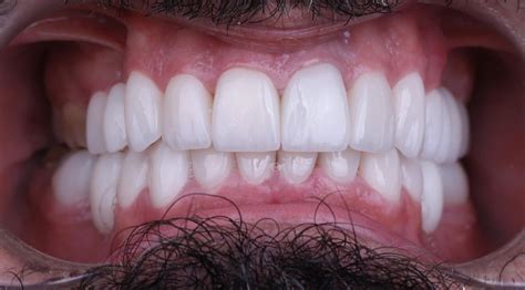 Crowned All My Teeth Raskdentists